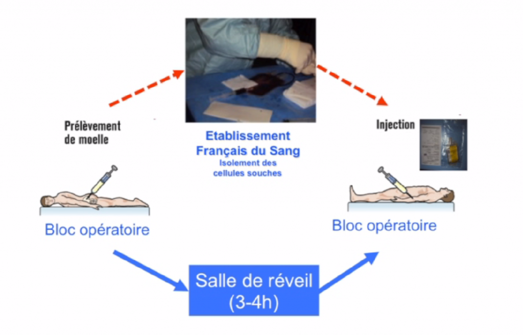 Troubles de l’érection après traitement d’un cancer de la prostate : L ...